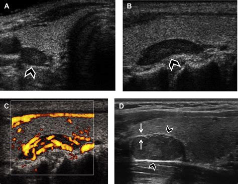 Parathyroid Imaging Radiologic Clinics