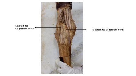 Demonstration Of Soft Parts Of Lower Limb Part