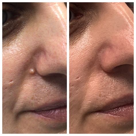 Mole Removal Before And After St Louis Dermatology And Cosmetic Surgery