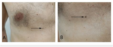 Combined Blue And Intradermal Nevus Of The Right Mid Chest Distant