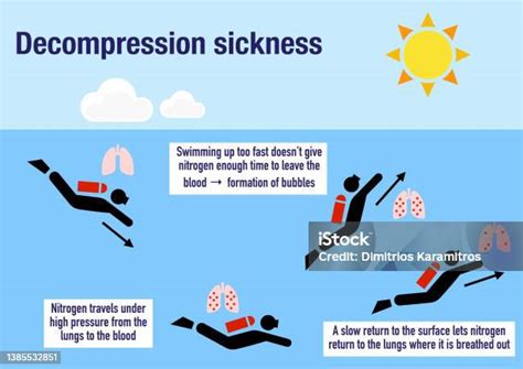 The Decompression Sickness Explained Stock Illustration Download Image Now Underwater Diving