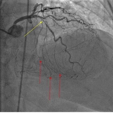 Left Anterior Descending Artery Showed 80 Stenosis Yellow Arrow With Download Scientific