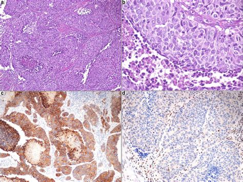 Pancreatic Neuroendocrine Carcinoma Showing Poorly Differentiated