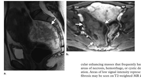 Gist A Sagittal T2 Weighted Mr Image Shows A Large Mass