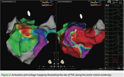 How Safe Is Ablation For Pvcs At Catherine Grant Blog