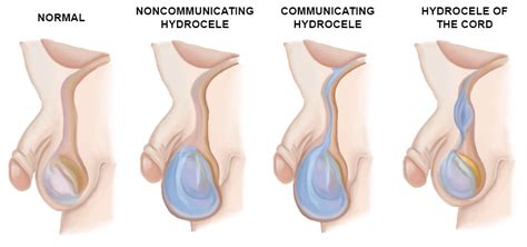 Congenital Hydrocele And Inguinal Hernia Pediatric Urology Book