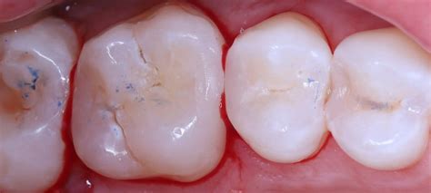 Treatment Of Interproximal Caries To Eliminate Food Impaction In Dubai