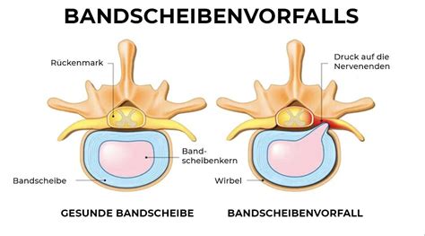 Was Sind Die Symptome Und Behandlungsmöglichkeiten Eines Bandscheibenv