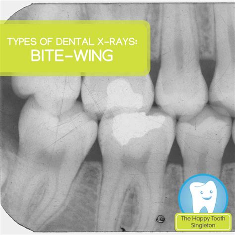 Types Of Dental X Rays Bite Wing The Happy Tooth Singleton