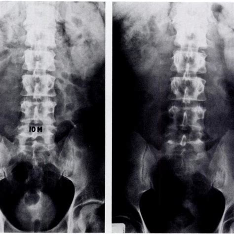 Pdf The Abnormal Nephrogram
