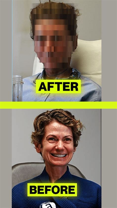 Athenix Throat Lift Before And After