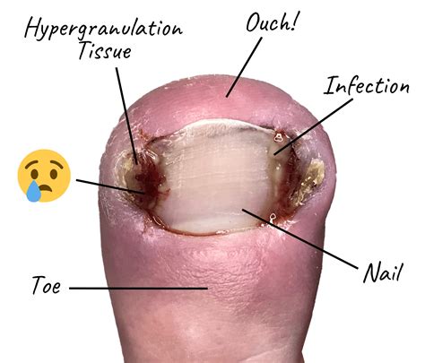 Purple Under Toenail Big Toe Toenail Falling Off What To Do Causes