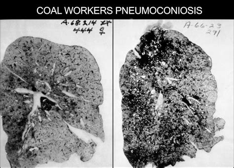 Free Black Lung Screenings Available For Coal Miners In Central Alabama