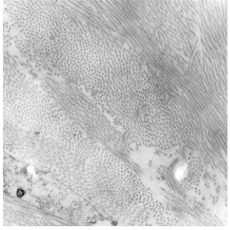 Pdf Restrictive Dermopathy A Rare Laminopathy