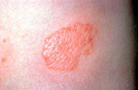 Tuberculosis Test Methods Results Risks And More