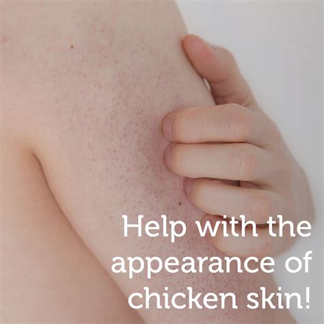 The Truth About Keratosis Pilaris Aproderm®