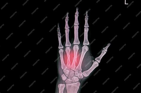 Premium Photo Hand Xray Showing Closed Fracture Third And Forth
