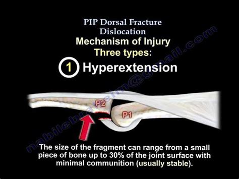 PIP Dislocations Flashcards OFF Pinnaxis Com