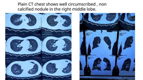 A Case Of Pulmonary Av Malformationpptx