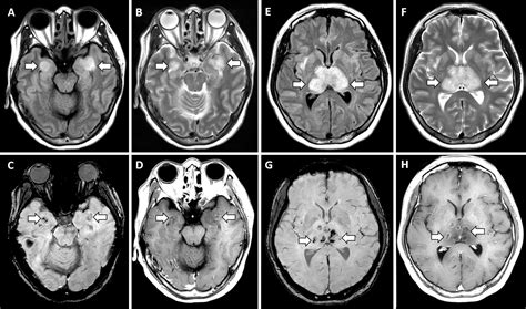 Encephalitis Mri