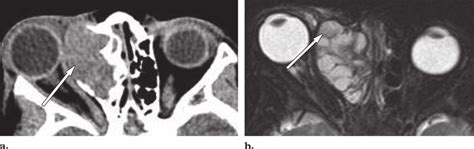Venous Lymphatic Malformation A Axial Nonenhanced Ct Image Obtained Download Scientific