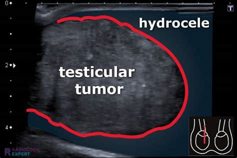 Scrotal Ultrasound