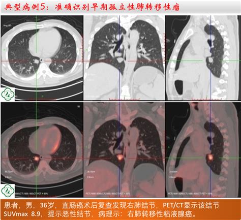 全景pet Ct肺结节精准代谢评估“早期肺癌早诊断” 特色技术 特色诊疗 就医版 山东第一医科大学第一附属医院（山东省千佛山医院）【官方网站】