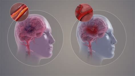Stroke Physiopedia