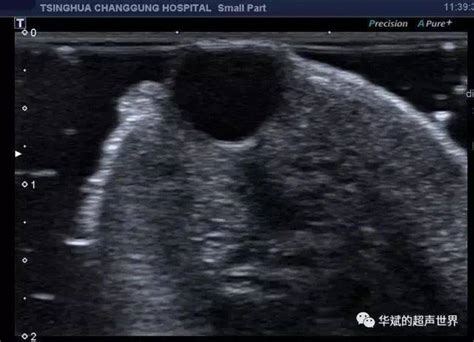 典型病例•中缝囊肿（ Median Raphe Cysts）阴茎尿道中线