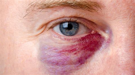 Black Eye What Causes Black Eyes And How To Get Rid Of Them