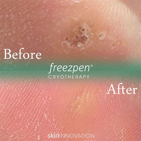 Wart Removal Skin Innovation