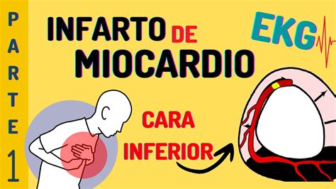 Infarto Agudo De Miocardio Cara Inferior Parte 1 Caso ClÍnico Ekg