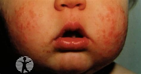 Gianotti Crosti Syndrome Image