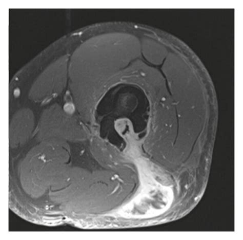 A 30 Year Old Systemically Well Man With Chronic Osteomyelitis Who Download Scientific Diagram