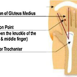 Determination According To The V Method Of Intramuscular Injection Site