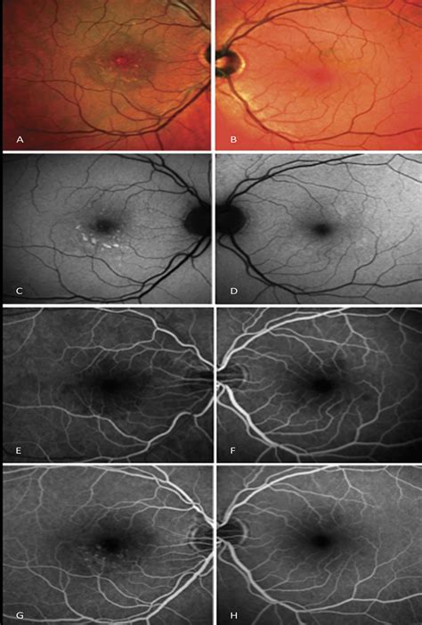 Persistent Placoid Maculopathy Imaged By Optical Coherence T Retinal Cases And Brief Reports