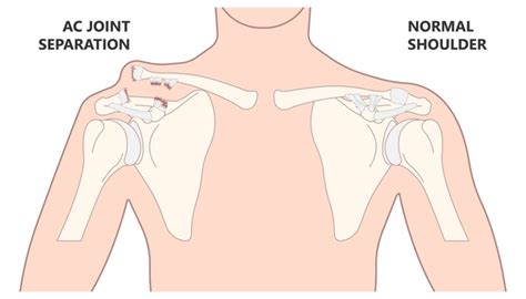 Acromioclavicular Joint Separation