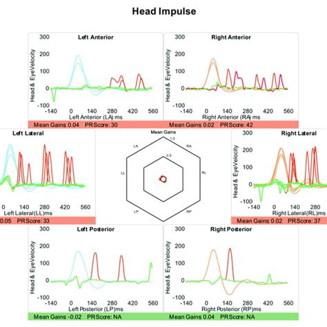 Graphical Representation Of An Abnormal Video Head Impulse Test Result Download Scientific