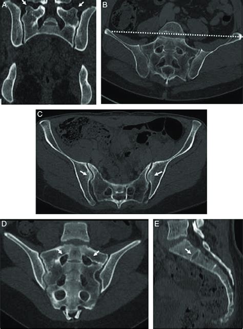 Ct Tomographic Signs Of Sacral Dysmorphism A Coronar Ct Scan Showing