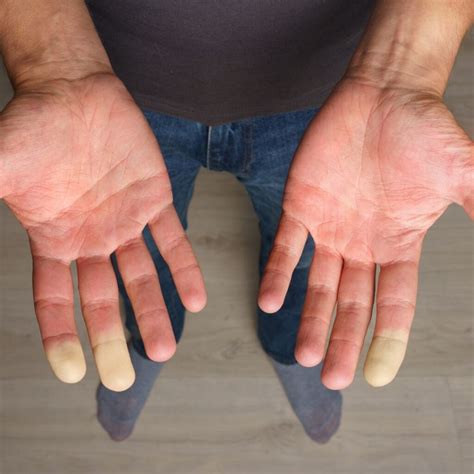 Raynauds Syndrome Overview Causes And Treatments