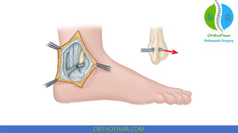 Peroneal Subluxation Symptoms Diagnosis Classification And Treatment
