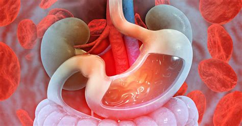 Can Gerd Cause Gi Bleed At Jennifer Colbert Blog