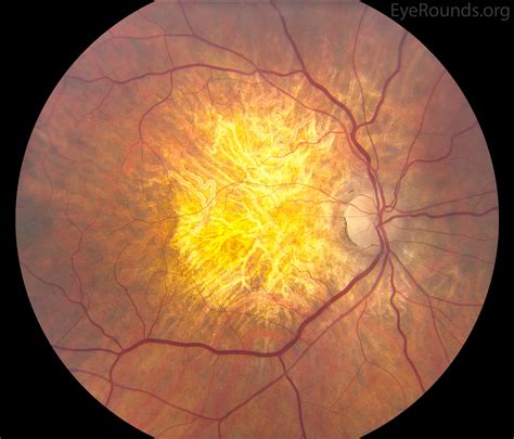 Age Related Macular Degeneration