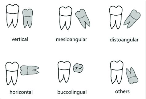 Illustrative Diagram Of Winter Classification Of Third Molar Angulation
