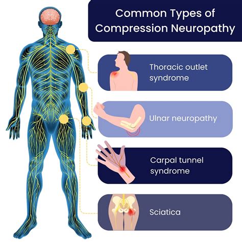 Compression Neuropathy Treatment Specialists In Brooklyn Nyc And Nj