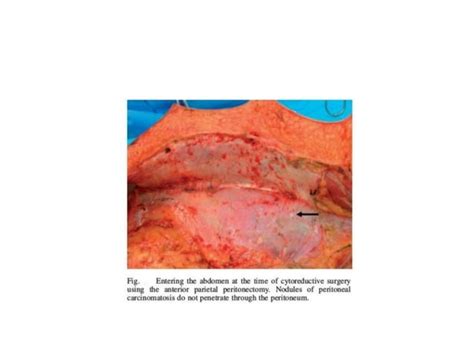 Hipec With Crs In Advanced Carcinoma Ovary Pptx