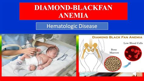 Diamond Blackfan Anemia Logo Ribosomal Protein Deficiencies Linked To