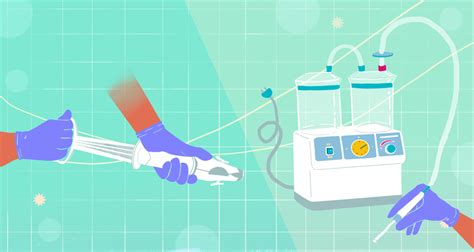 What Is Manual Vacuum Aspiration At Timothy Arrington Blog