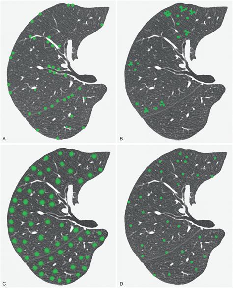 Interstitial Patterns Clinical Tree