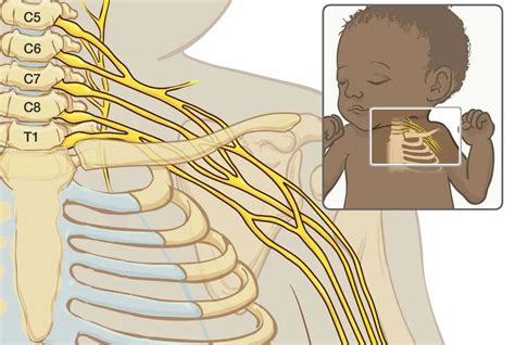 The Armdoc Comprehensive Guide To Erbs Palsy Brachial Plexus Birth